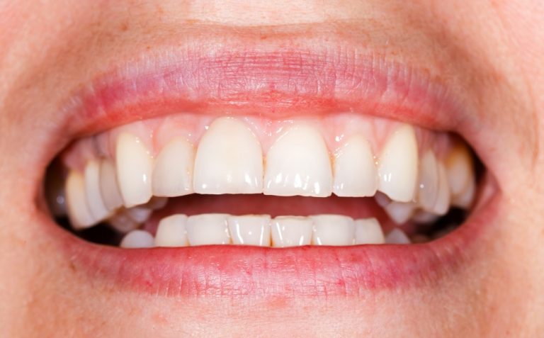 Tooth Truth: Everything to Know About Your Canines | Fort Worth Dentist ...