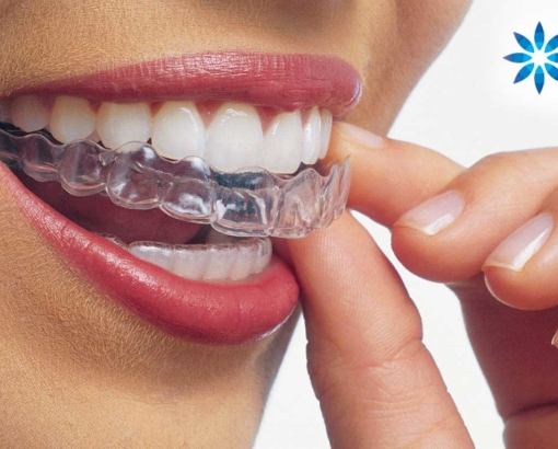 What's Involved in Using Invisalign for Tooth Alignment? | Fort Worth ...