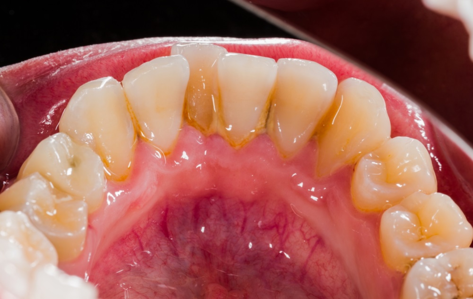 A Case of Crooked Front Teeth and Dental Malocclusion